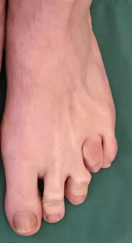 Toe lengthening - Dr. Michael Vitek | 1120 Wien