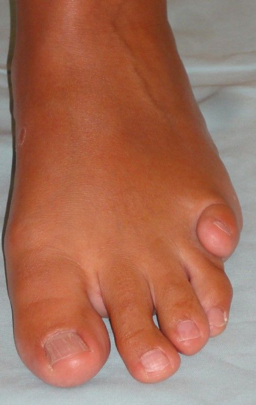 Zehenverlängerung - Dr. Michael Vitek | 1120 Wien