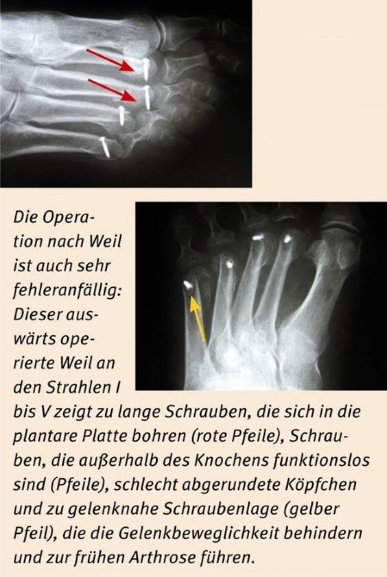 Splayfoot problems - Dr. Michael Vitek | 1120 Vienna