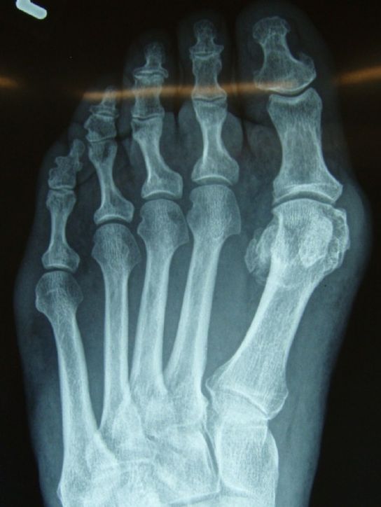 Hammerzehen - Dr. Michael Vitek | 1120 Wien