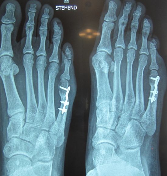 Taylor's Bunion - Dr. Michael Vitek | 1120 Vienna