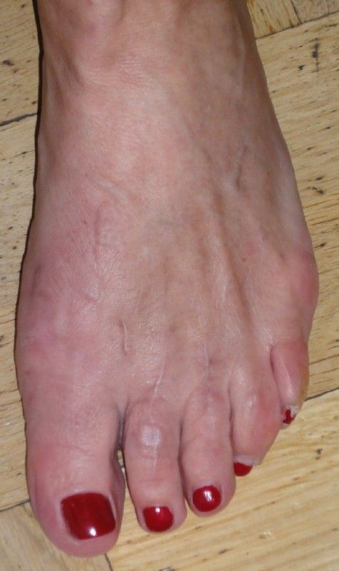 Hammerzehen - Dr. Michael Vitek | 1120 Wien