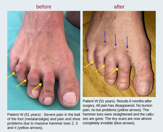2. Operative extensions or shortening of toes