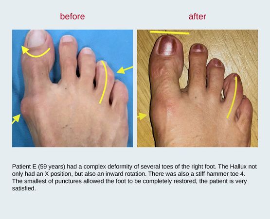 2. Operative extensions or shortening of toes