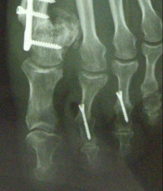 Hammerzehen - Dr. Michael Vitek | 1120 Wien