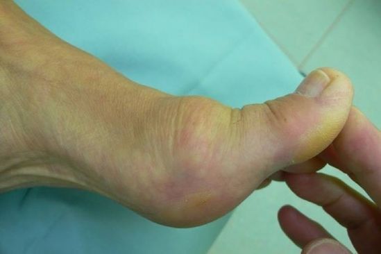 Hallux Limitus & Hallux Rigidus - Dr. Michael Vitek