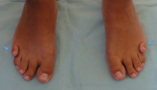 Claw toes - Dr. Michael Vitek