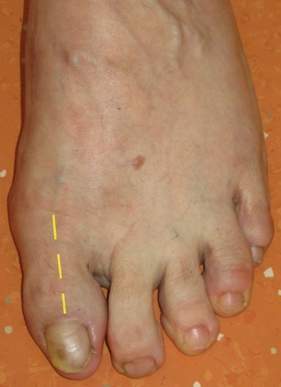 Interphalangeus Hallux Valgus - Dr. Michael Vitek