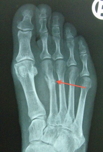 Injuries - Dr. Michael Vitek