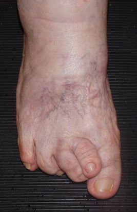 Hammerzehen - Dr. Michael Vitek | 1120 Wien