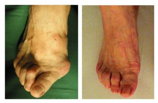 Hallux valgus - Dr. Michael Vitek | 1120 Wien