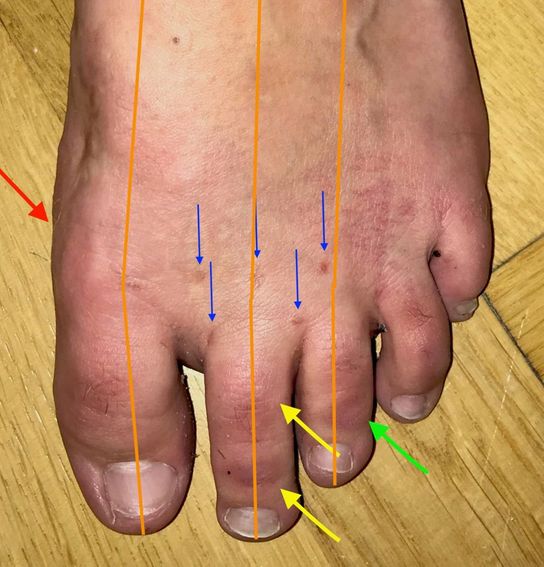 Hammerzehen - Dr. Michael Vitek | 1120 Wien