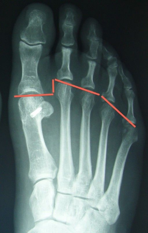 Splayfoot problems - Dr. Michael Vitek | 1120 Vienna