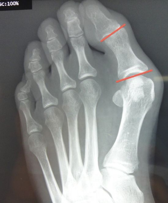 Interphalangeus Hallux Valgus - Dr. Michael Vitek