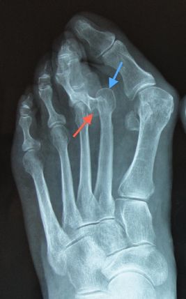 Hammerzehen - Dr. Michael Vitek | 1120 Wien